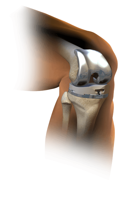Knee Replacement Solutions | MicroPort Orthopedics